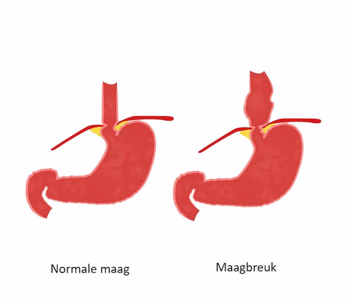 Mogen we binnenkort geen maagzuurremmers meer slikken? Expert tipt dé ...