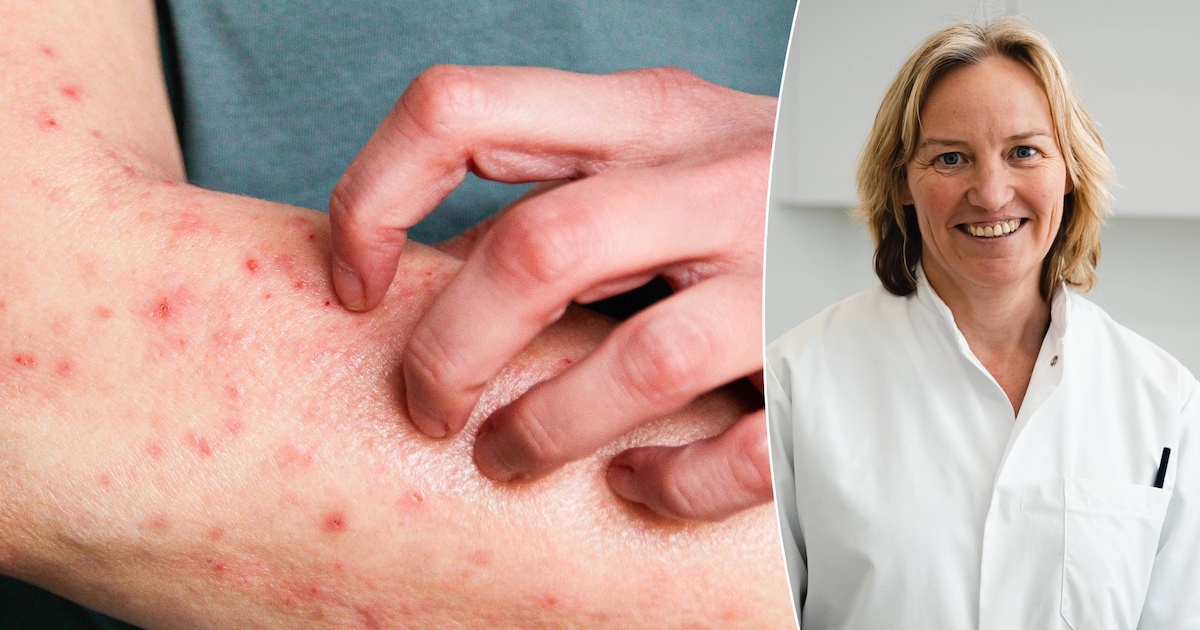 Wat is atopisch eczeem, en waarom verergert het in de winter? “Zonder ...