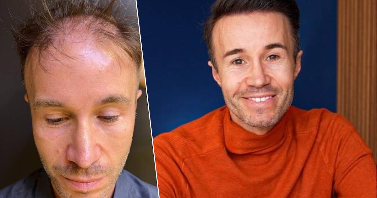 Zanger Ivann (42) van ‘X Factor’ maakt podcast over haaruitval: “Voor ...