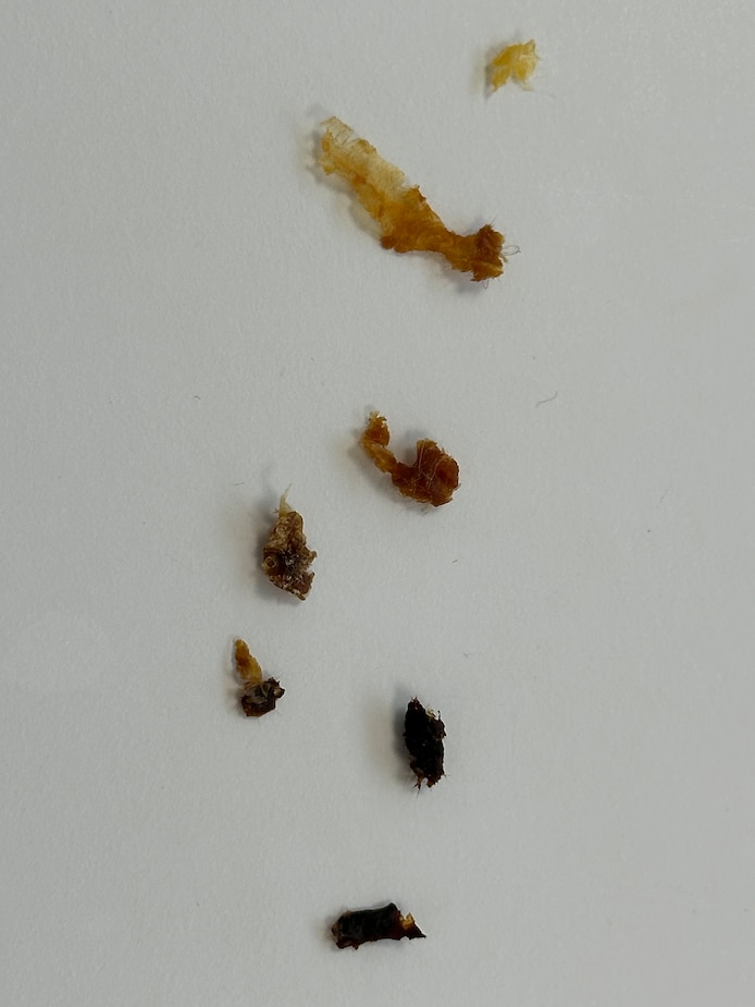 “Hoe ouder, hoe dikker het zal worden”: NKO-arts over de twee ...