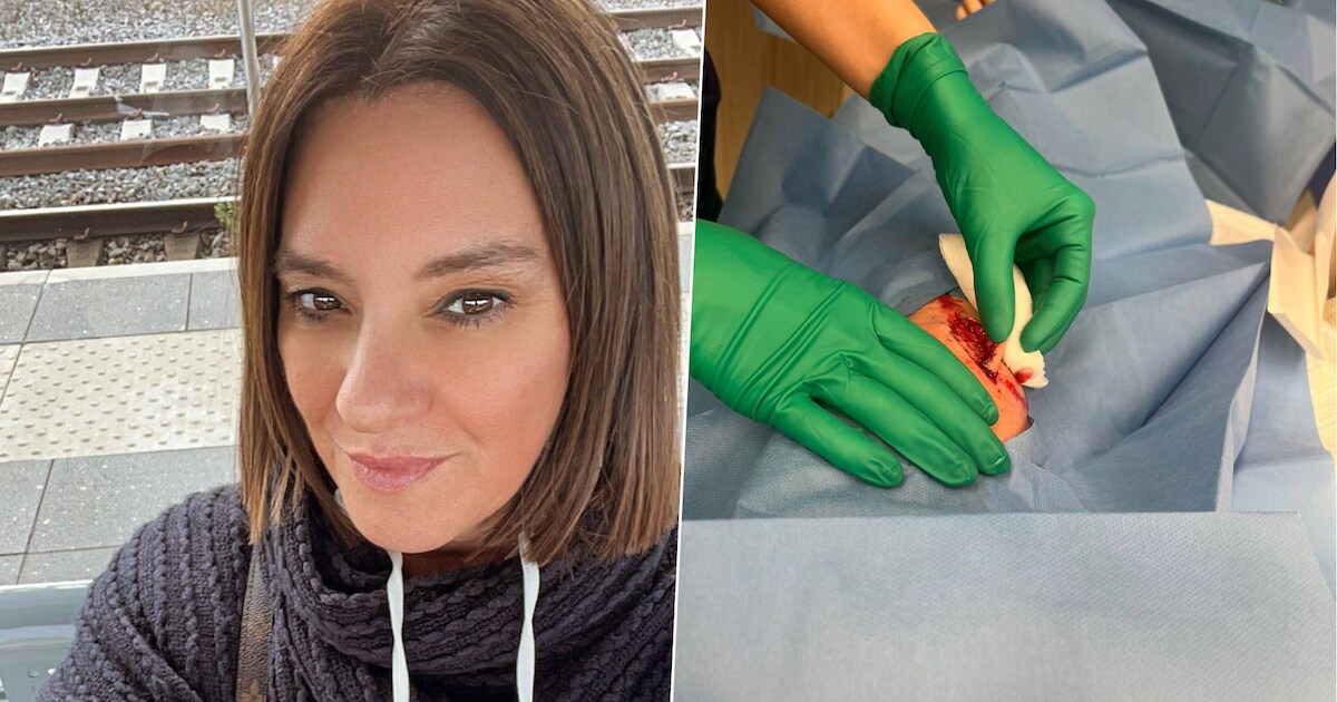 Uiteenspattende Coca-Cola fles bezorgt Sonja 10 hechtingen in onderbeen ...