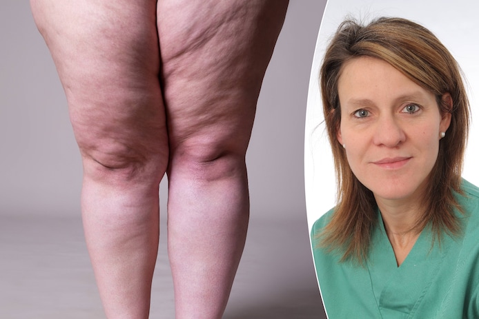 “Een slank bovenlichaam en veel te zware benen kunnen wijzen op ...