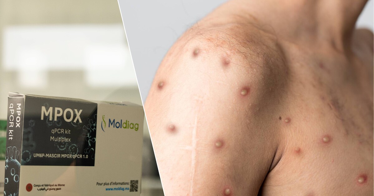 België rapporteert eerste besmetting met nieuwe mpox-variant | Medisch ...