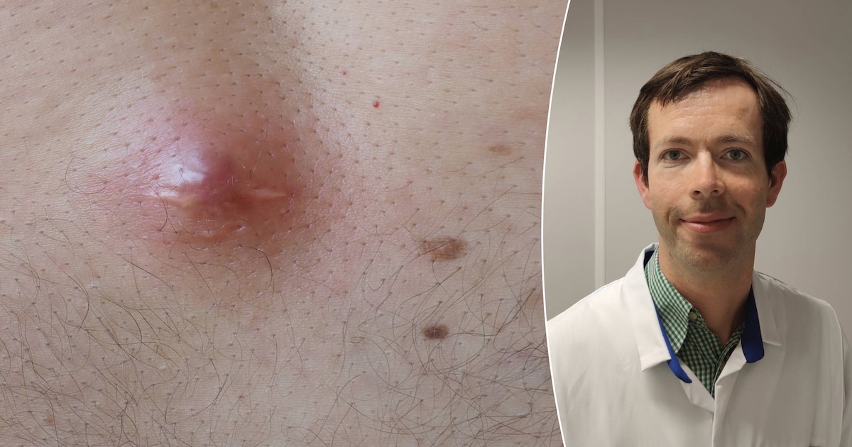 “Sommige producten verhogen de kans op een steenpuist”: zo herken en ...