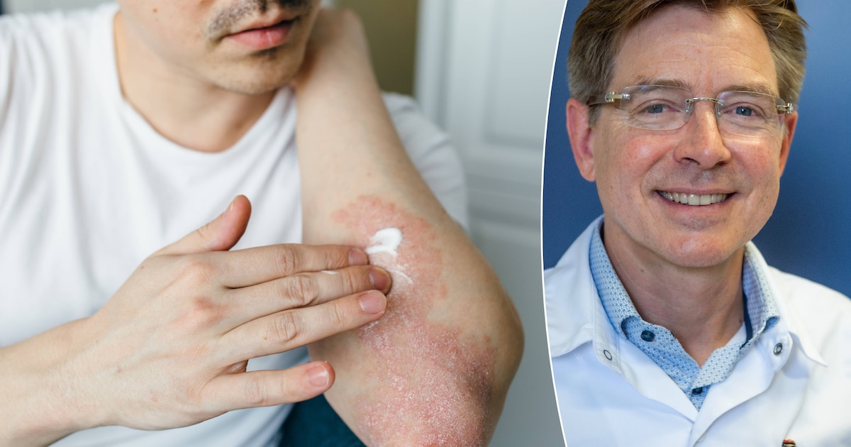 Hoe herken je eczeem? Dermatoloog: “Je moet het anders behandelen in de ...