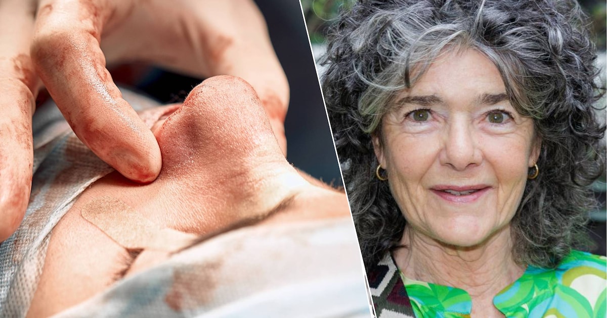 Nederlandse presentatrice moet neus volledig laten amputeren. Arts: “Erg uitzonderlijk, maar ...