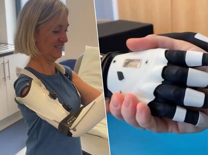 KIJK. Britse vrouw is eerste gebruiker ooit van bionische arm met AI ...
