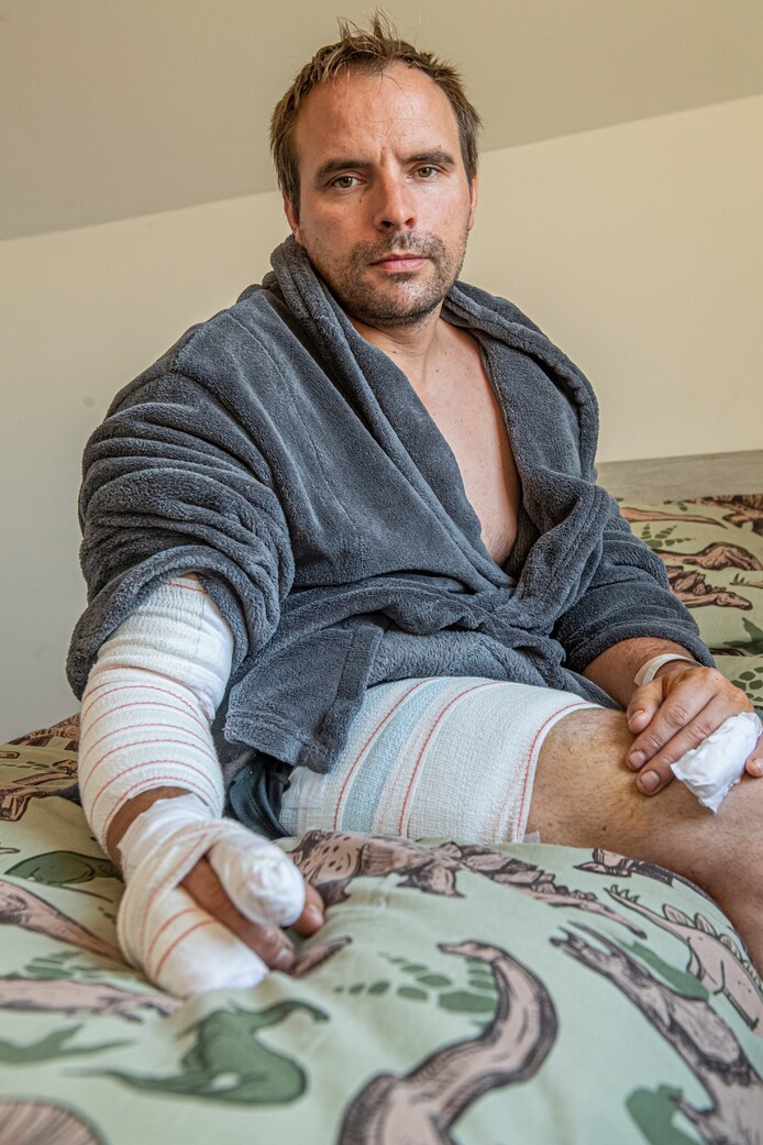 West-Vlaming zwaar verbrand door e-sigaret in broekzak: “Een geluk: hij is niet in mijn mond ...