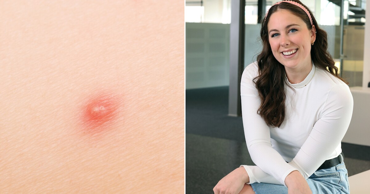 Marie Verhulst is dol op puistjes uitknijpen: jij ook? Experts leggen ...