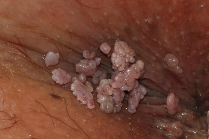 “Na de besmetting kan het weken of maanden duren voor je zelf de ...