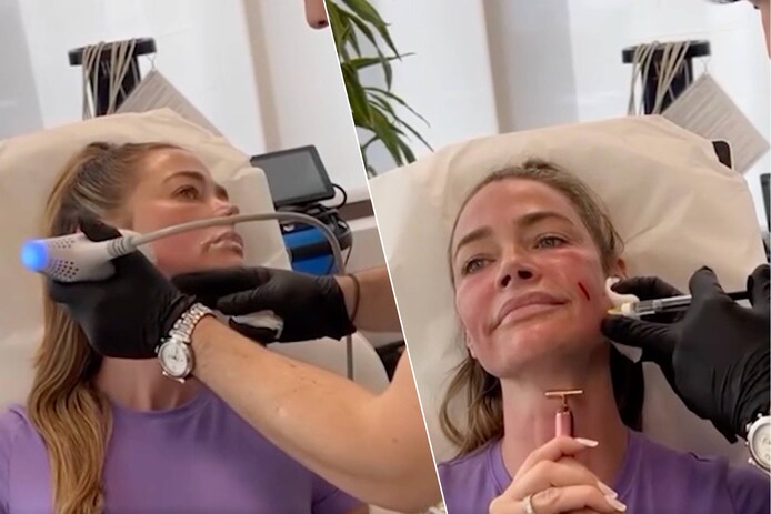Wie mooi wil zijn, moet pijn lijden? Denise Richards kiest voor peperdure behandeling met ...