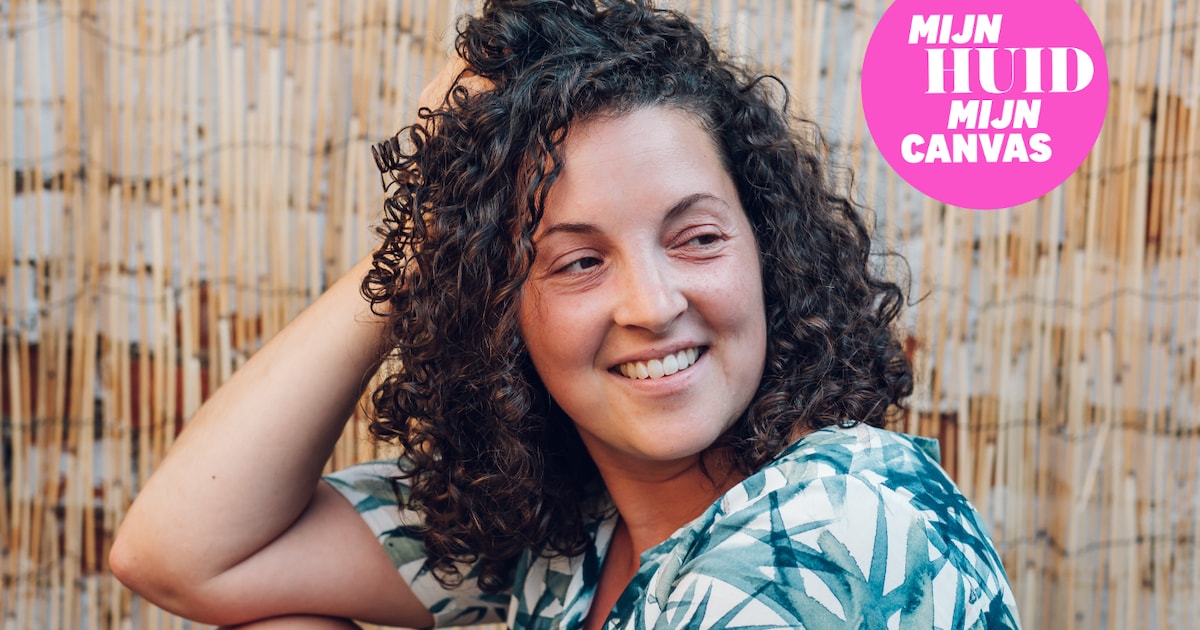 Elke heeft al heel haar leven eczeem: “Op sommige dagen is het zo erg ...