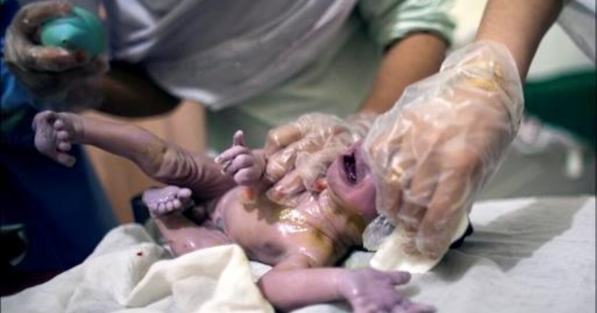 2,7 procent van Antwerpse pasgeborenen heeft aangeboren afwijking ...