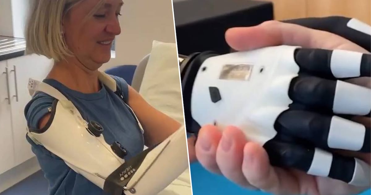 KIJK. Britse vrouw is eerste gebruiker ooit van bionische arm met AI ...