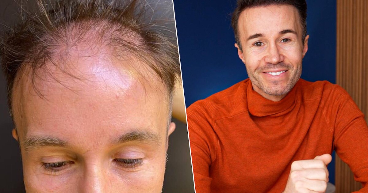 Ivann Vermeer maakt podcast over haarverlies: "Zonder oplossing ging ...