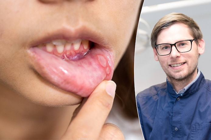 “Niet gevaarlijk, wel besmettelijk”: welke producten helpen tegen aften ...