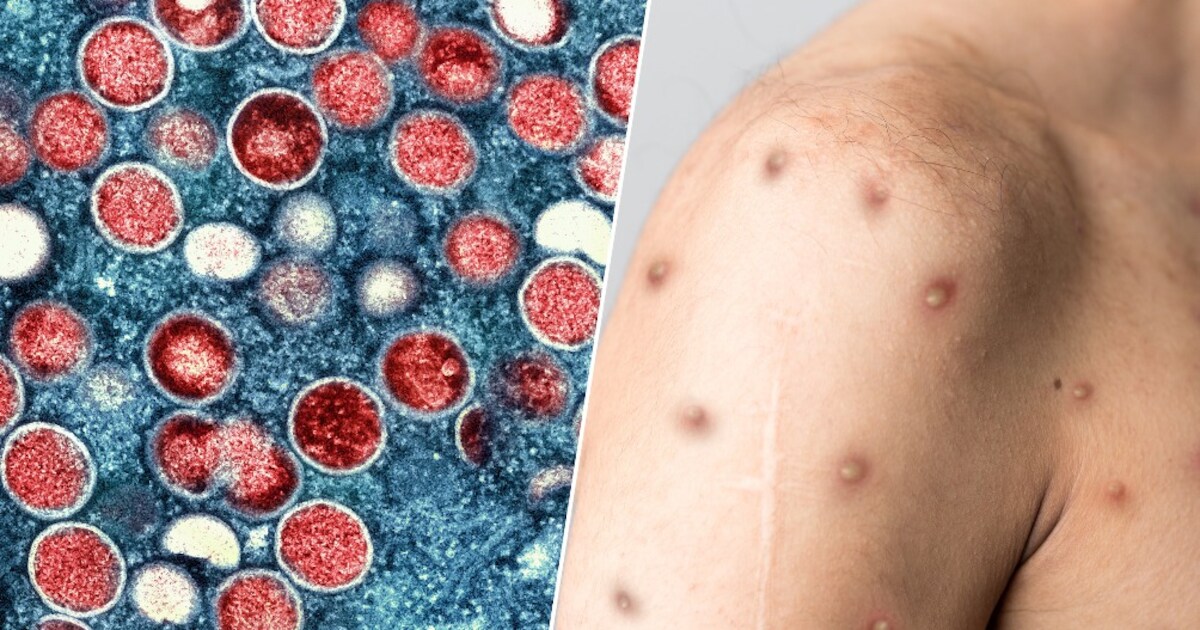 Chinese douane gaat mensen en goederen controleren op mpox, het ...