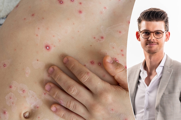 Waarom mag je kind nu plots tóch naar school met windpokken? En waarom ...