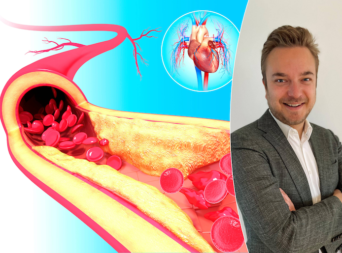 Cardiologen vragen verplichte screening slagaderverkalking: “Meer doden ...