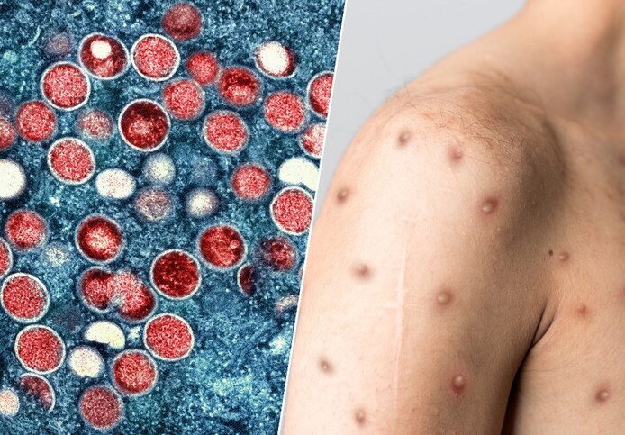 Chinese douane gaat mensen en goederen controleren op mpox, het ...