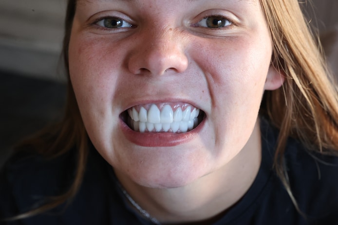 Na een jaar zonder tanden krijgt Alana (26) nieuw gebit: “De grootste ...