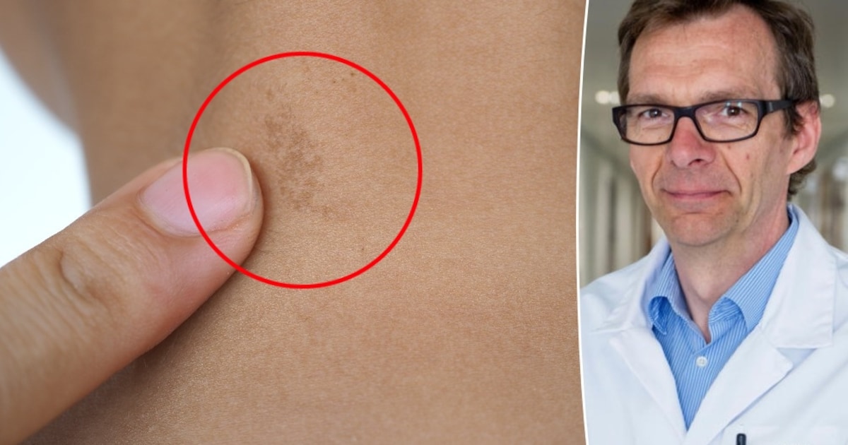 “Neurofibromatose is weinig gekend, maar niet zo zeldzaam”: wat is deze ...